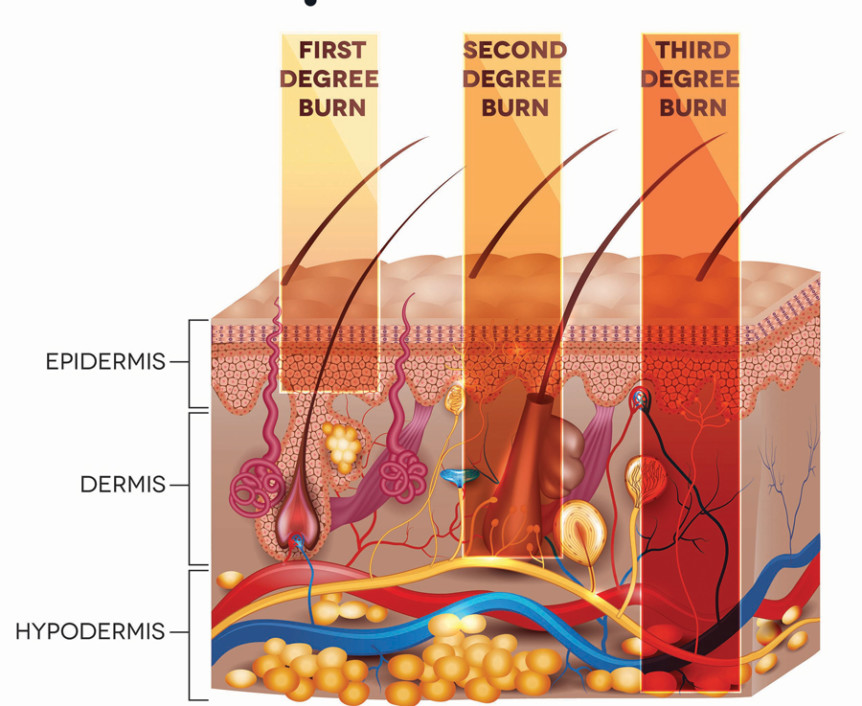 Electrical and Thermal Burns: Why Is This an Important Topic in NFPA ...